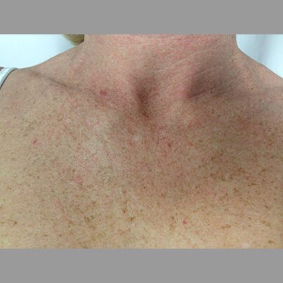 Before & After Images - Body - Australian Skin Face Body